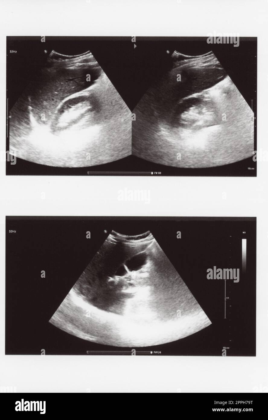 full abdomen ultrasound sonogram Stock Photo - Alamy