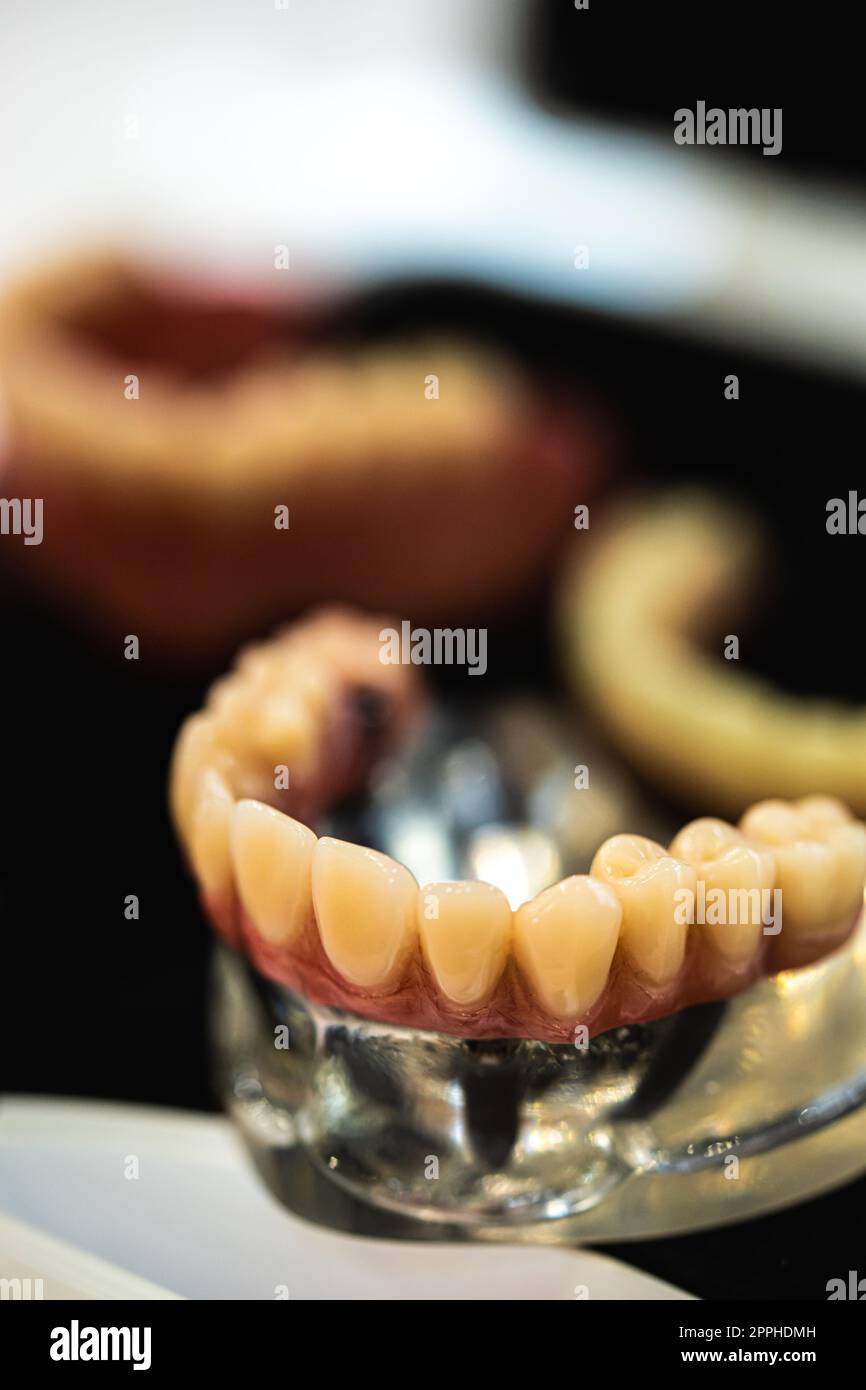 Dental prosthesis with metal Stock Photo - Alamy