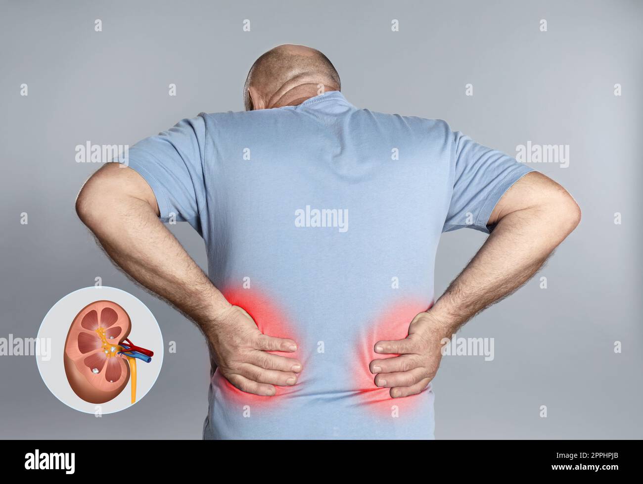 Kidney Stone Pain Location Male