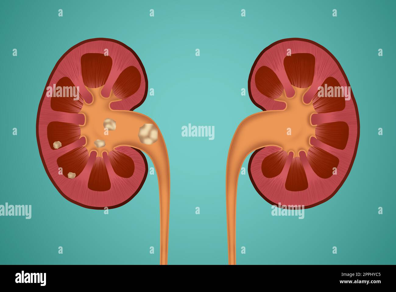 Illustration of human kidneys, one with stones on blue background Stock ...