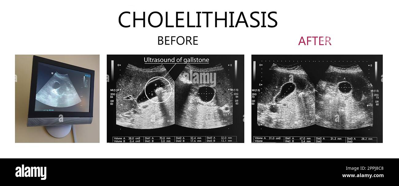 Ultrasonography image of gallbladder with gall stones at upper abdomen ...