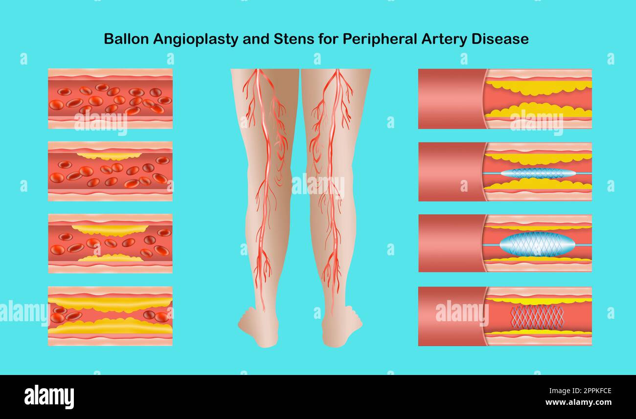 Diagram showing angioplasty for peripheral artery disease illustration ...