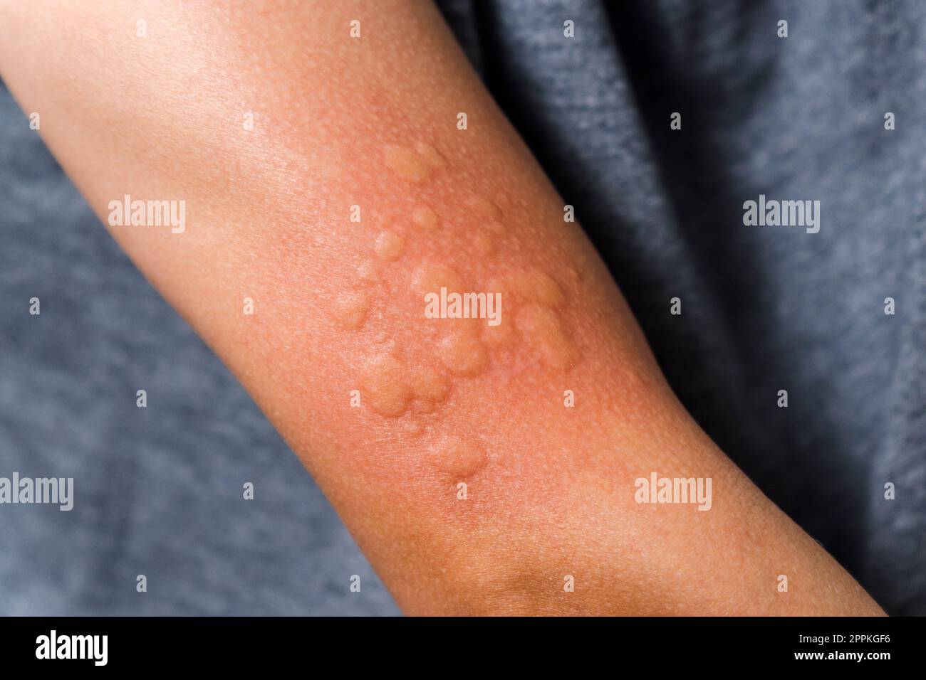 Skin allergy test hi-res stock photography and images - Alamy