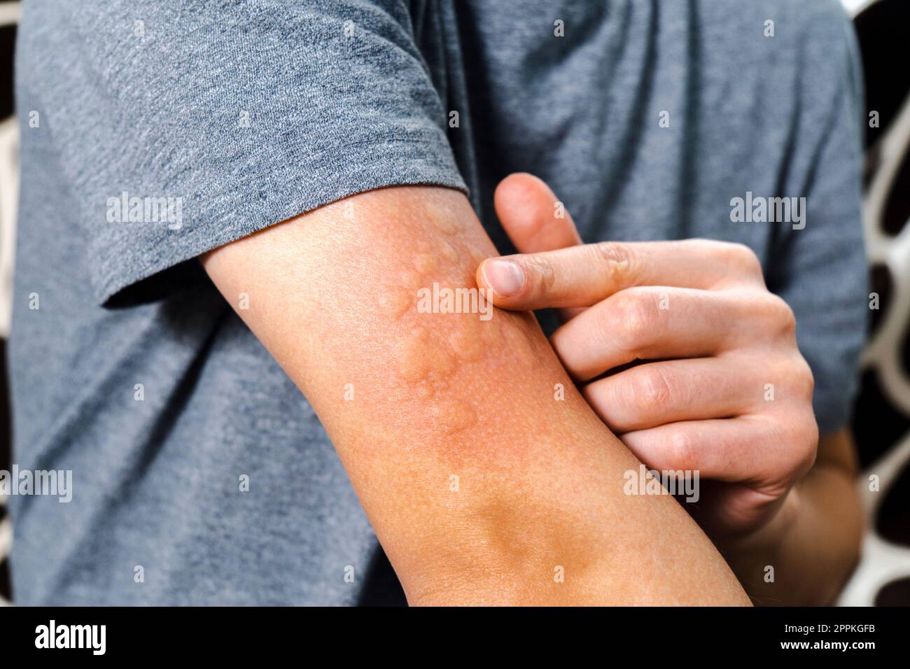Skin rash and swelling on man arm, immunizations prevent infectious ...
