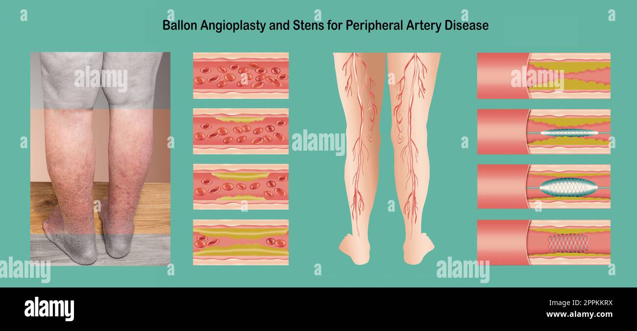 Diagram showing angioplasty for peripheral artery disease illustration ...