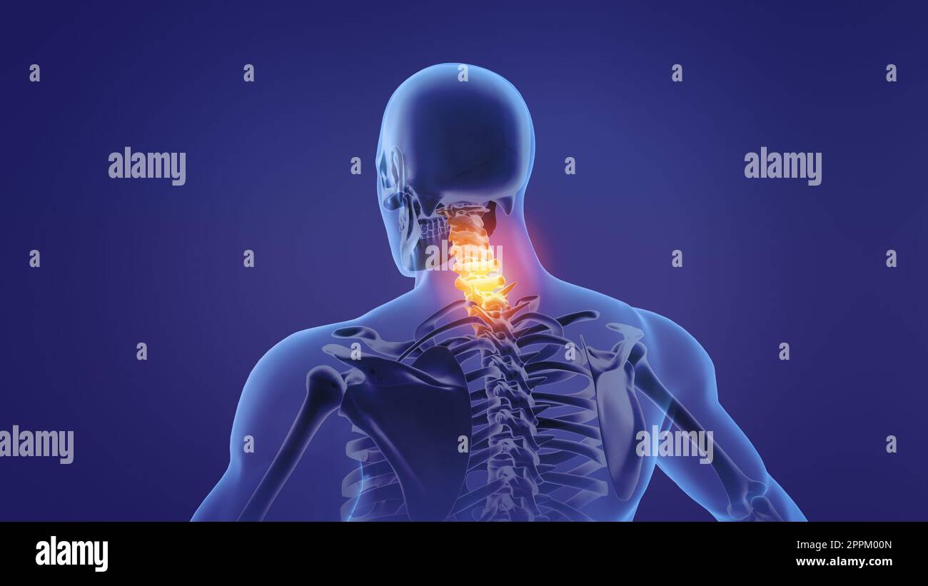 Animation of a painful neck Stock Photo - Alamy
