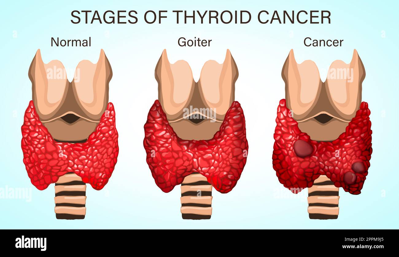 Set with illustration of healthy and diseased thyroid on light ...