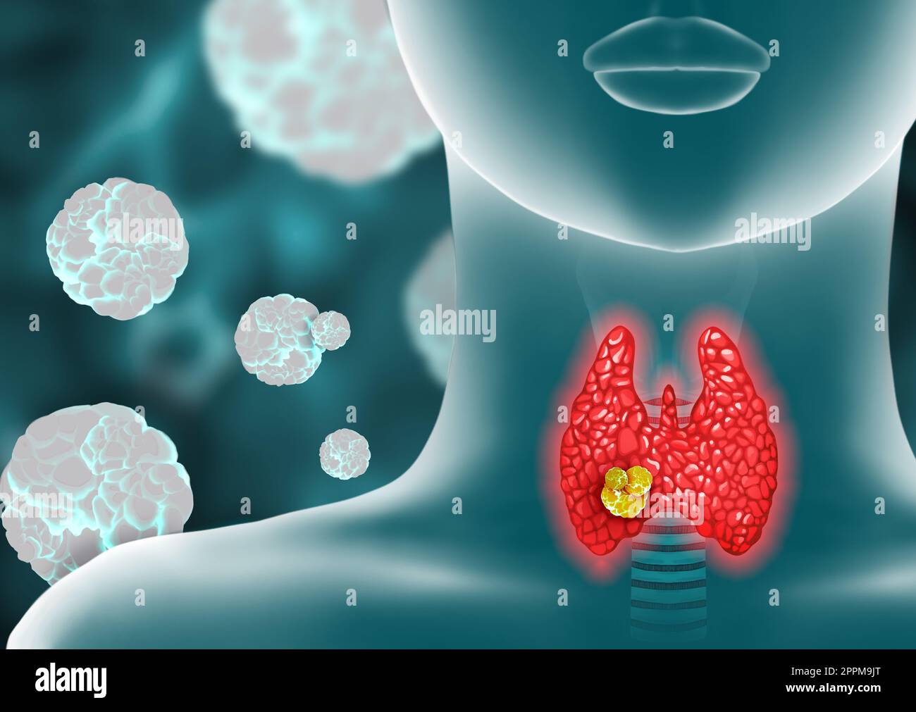 Illustration of human thyroid cancer on color background Stock Photo ...