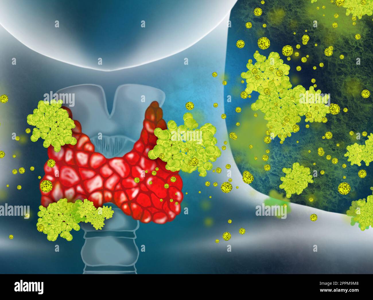 Illustration of human thyroid cancer on color background Stock Photo ...