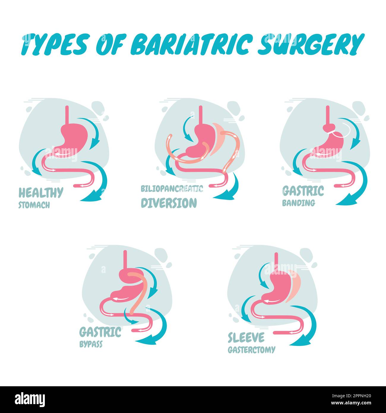 Types of bariatric surgery, it is process for the digestive system in ...