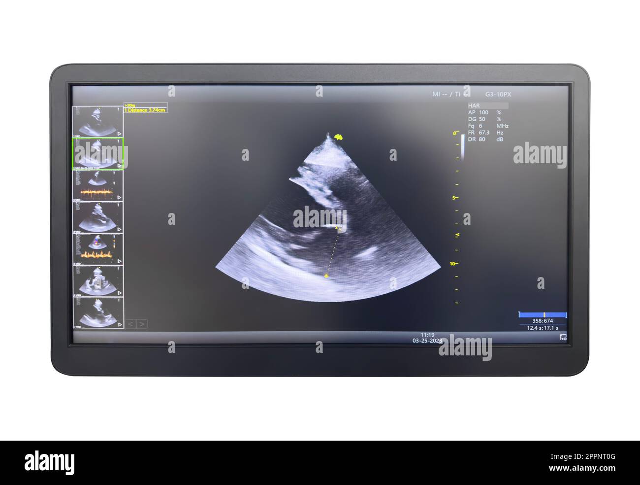 Utrasound image on the monitor close-up. Ultrasound scan examination on ...