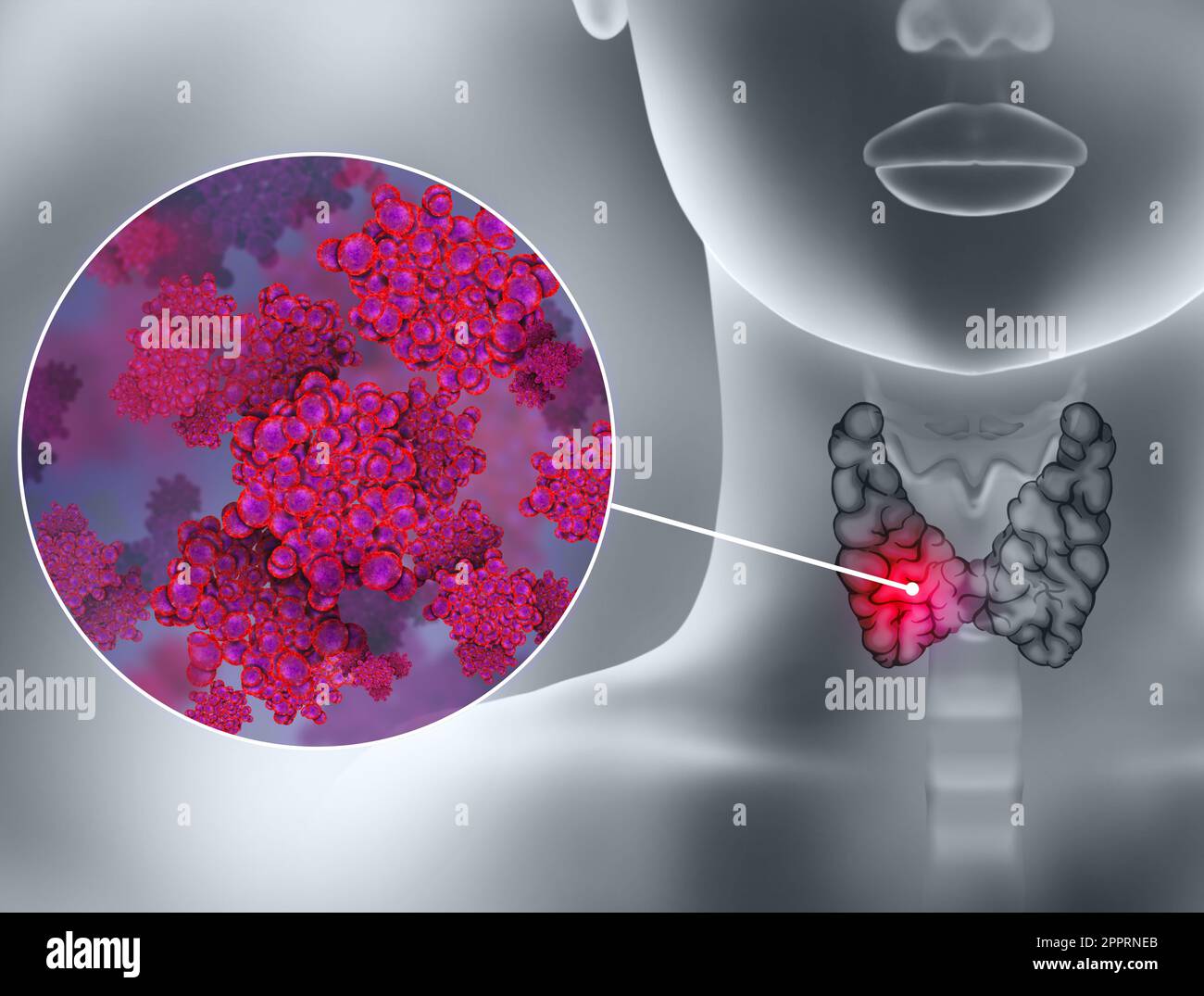 Illustration of human thyroid cancer on grey background Stock Photo - Alamy