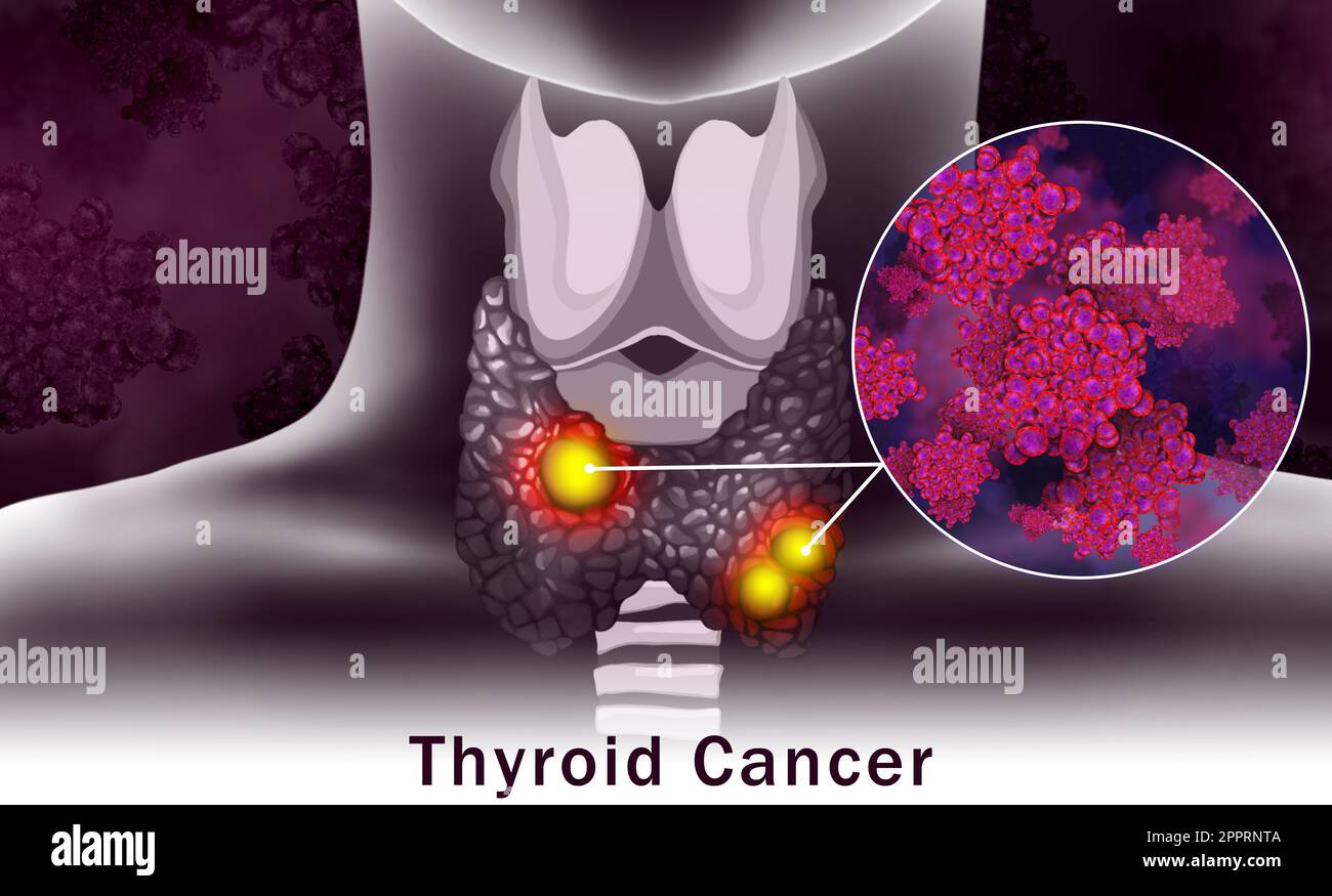 Illustration of human thyroid cancer on color background Stock Photo ...