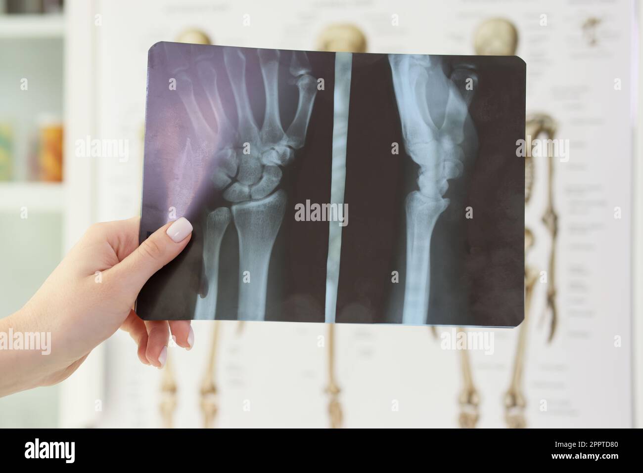 Palm bones hi-res stock photography and images - Alamy