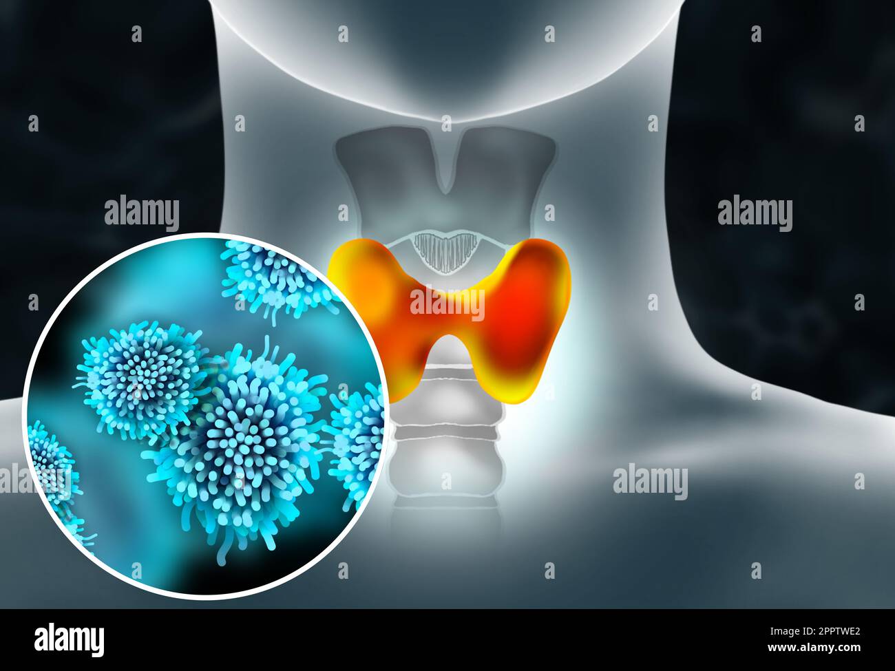 Illustration of human thyroid cancer on dark background Stock Photo - Alamy