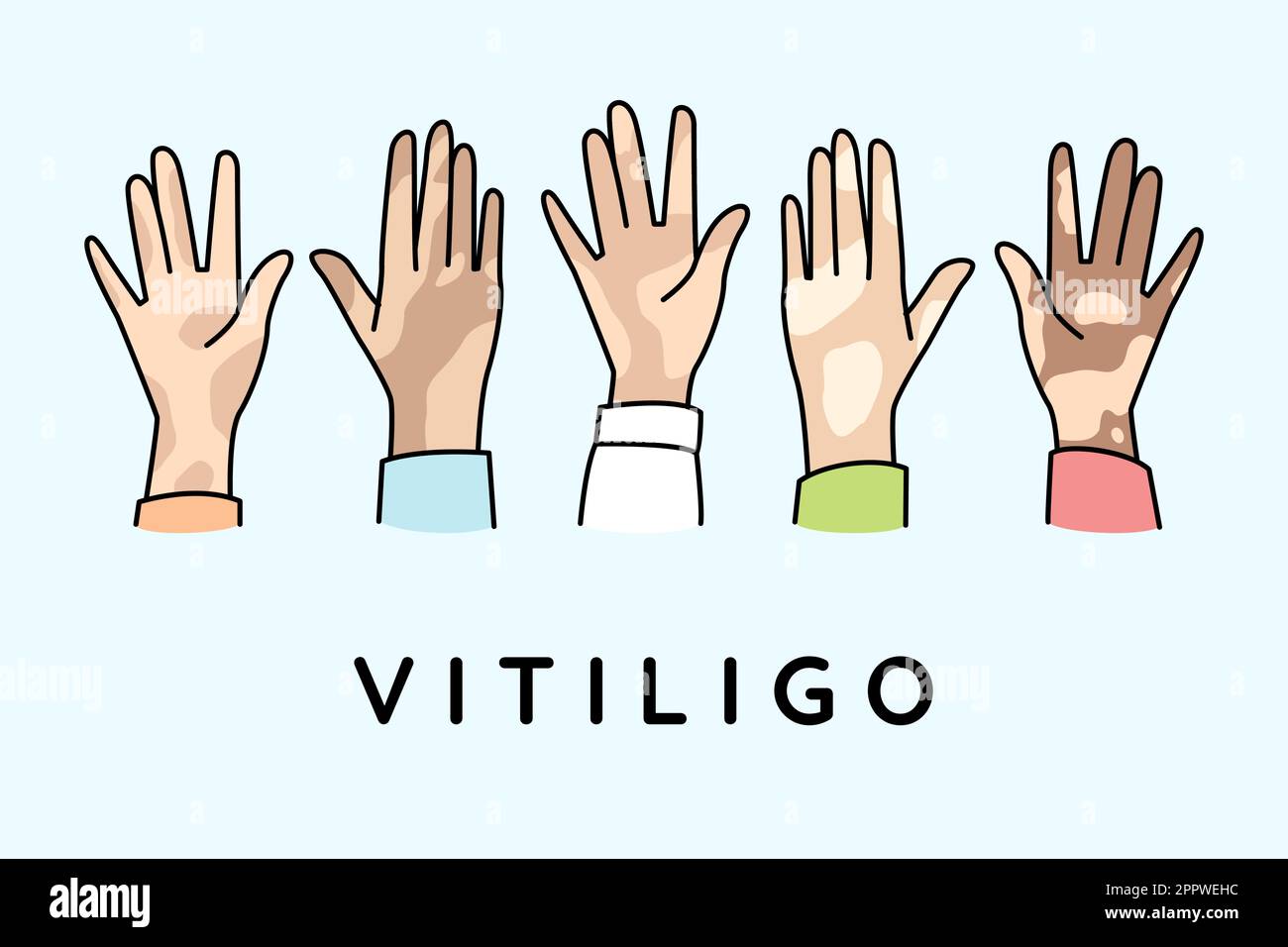 People hands with vitiligo Stock Vector Image & Art - Alamy