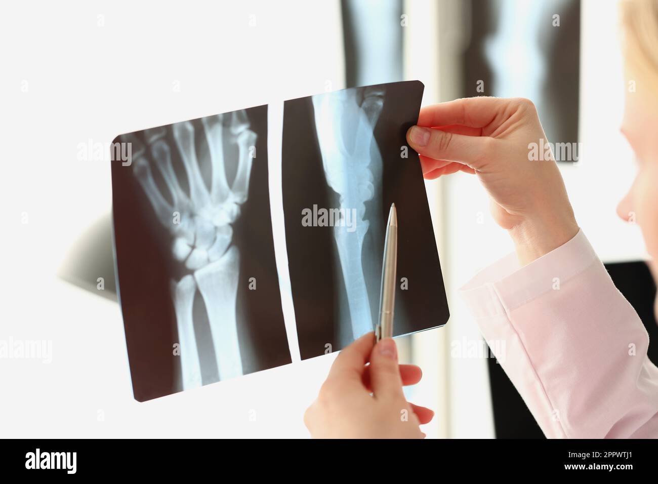 female doctor looks at x-ray of a arm injury in hospital Stock Photo ...