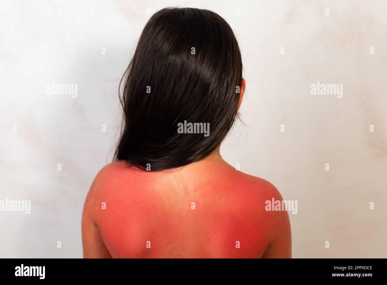 Back of black haired girl with severe red burns after spending time in sun, gray background ...
