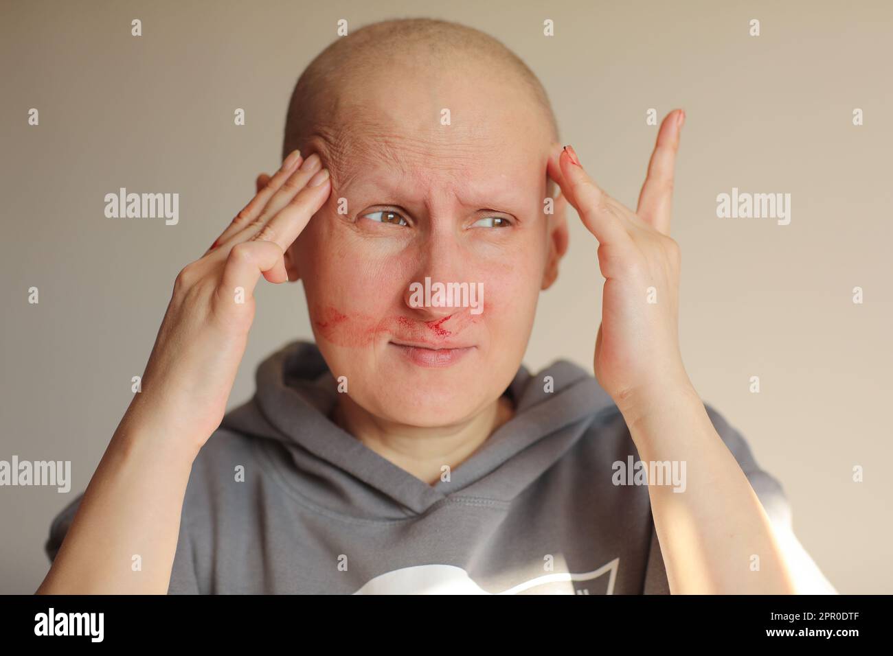 Bald cancer sick woman is bleeding from her nose, effects of ...