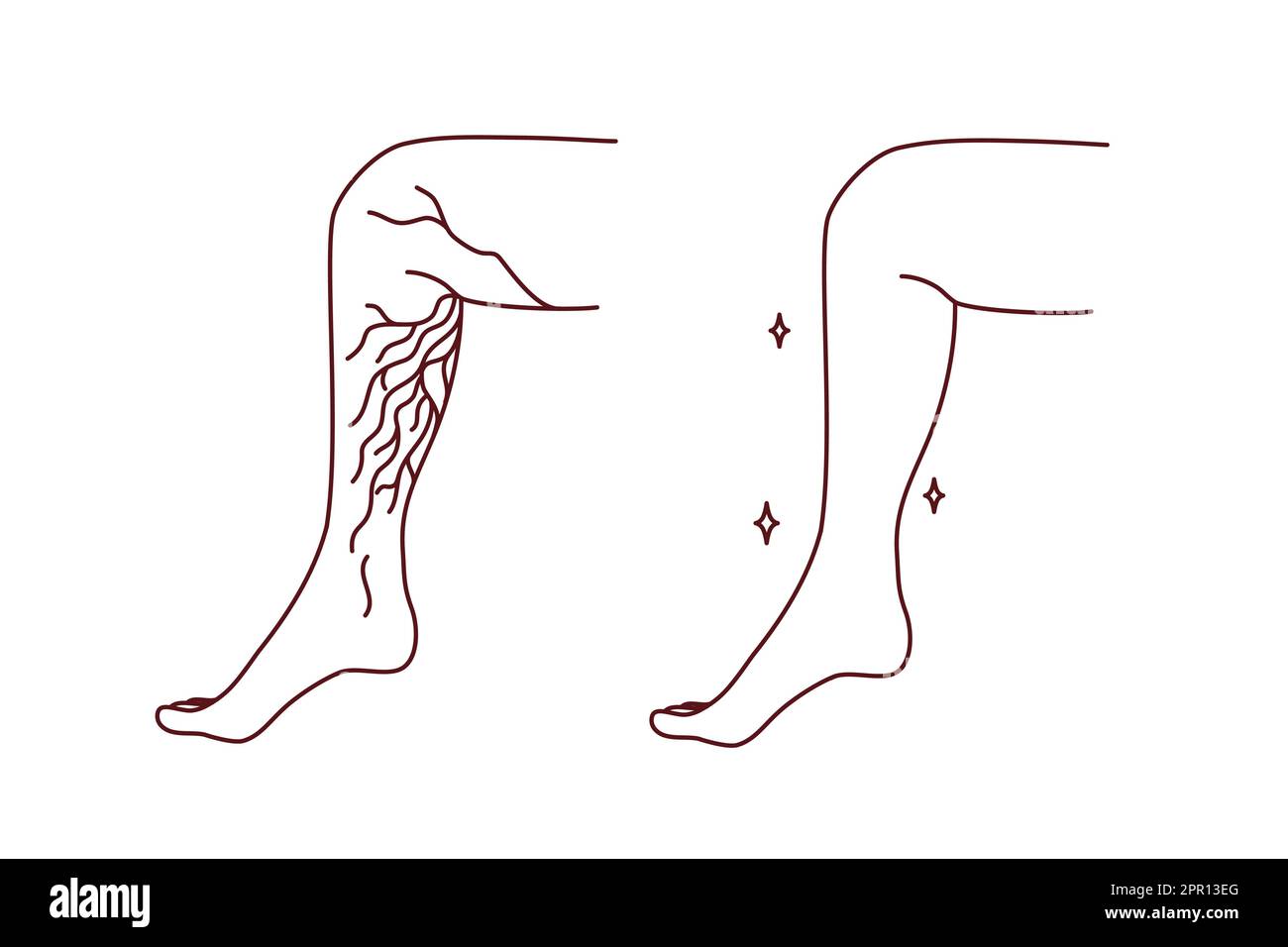 Thrombosis leg Stock Vector Images - Alamy