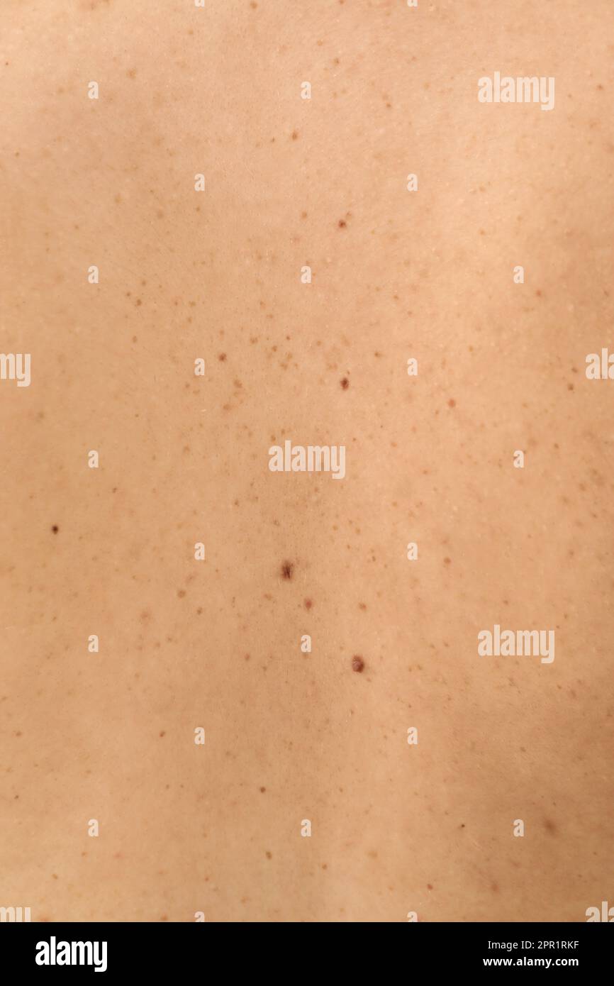 Closeup of woman's body with birthmarks as background Stock Photo - Alamy