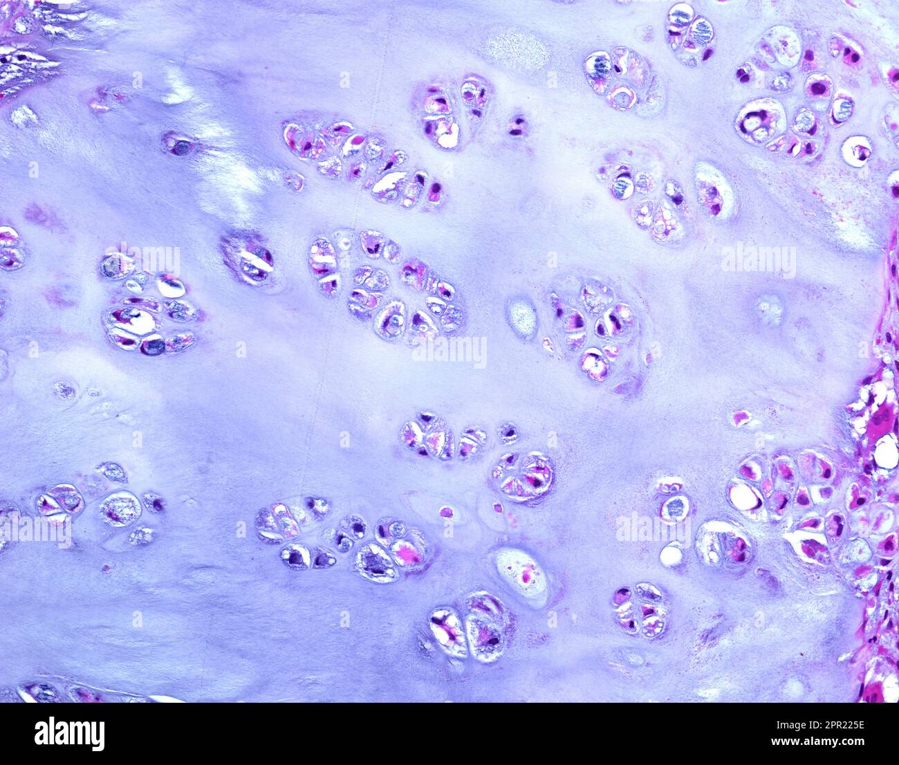 Chondrosarcoma, light micrograph Stock Photo - Alamy
