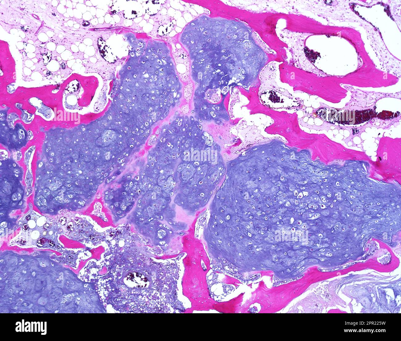 Chondrosarcoma, light micrograph Stock Photo - Alamy