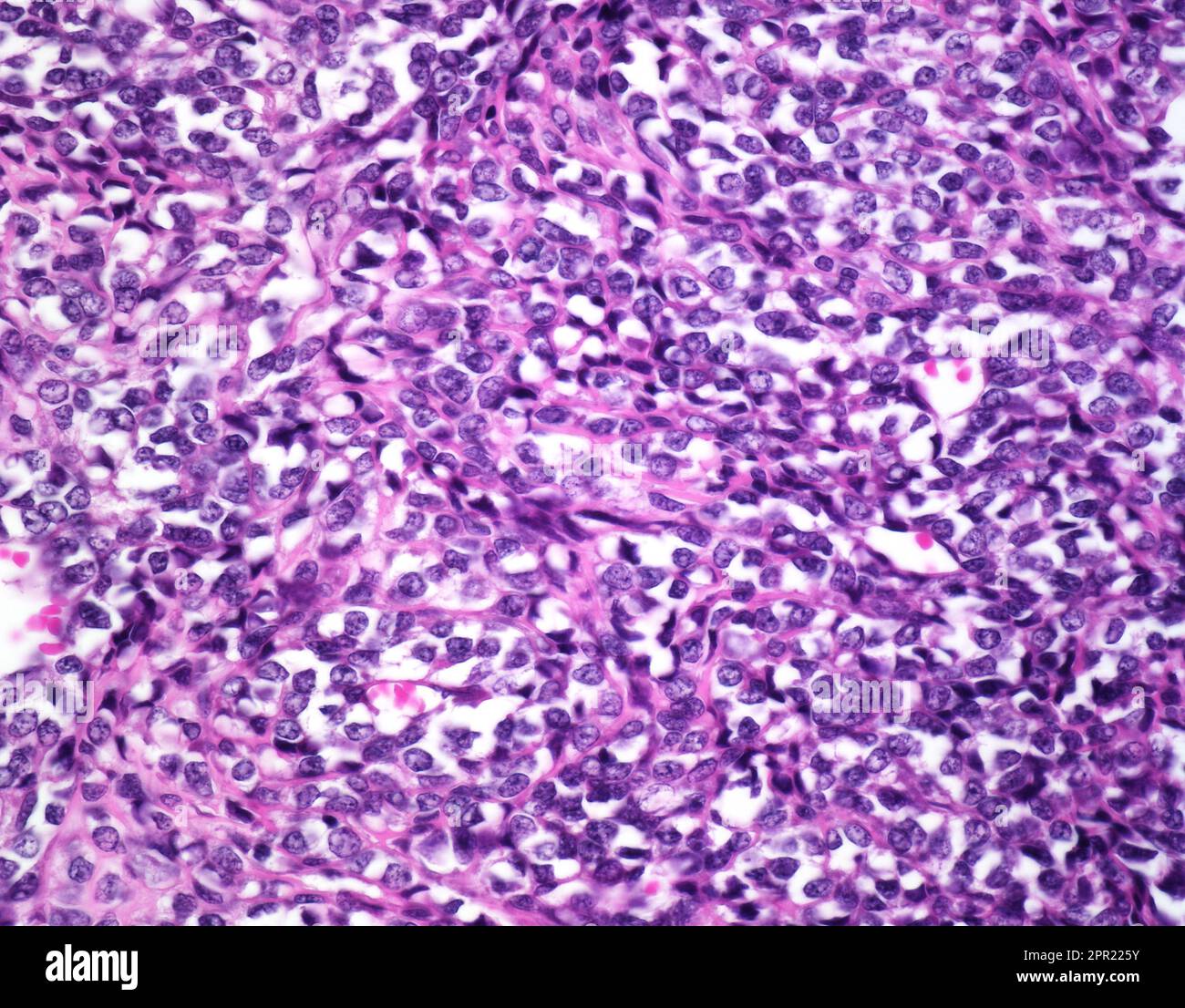 Mesenchymal chondrosarcoma, light micrograph Stock Photo - Alamy