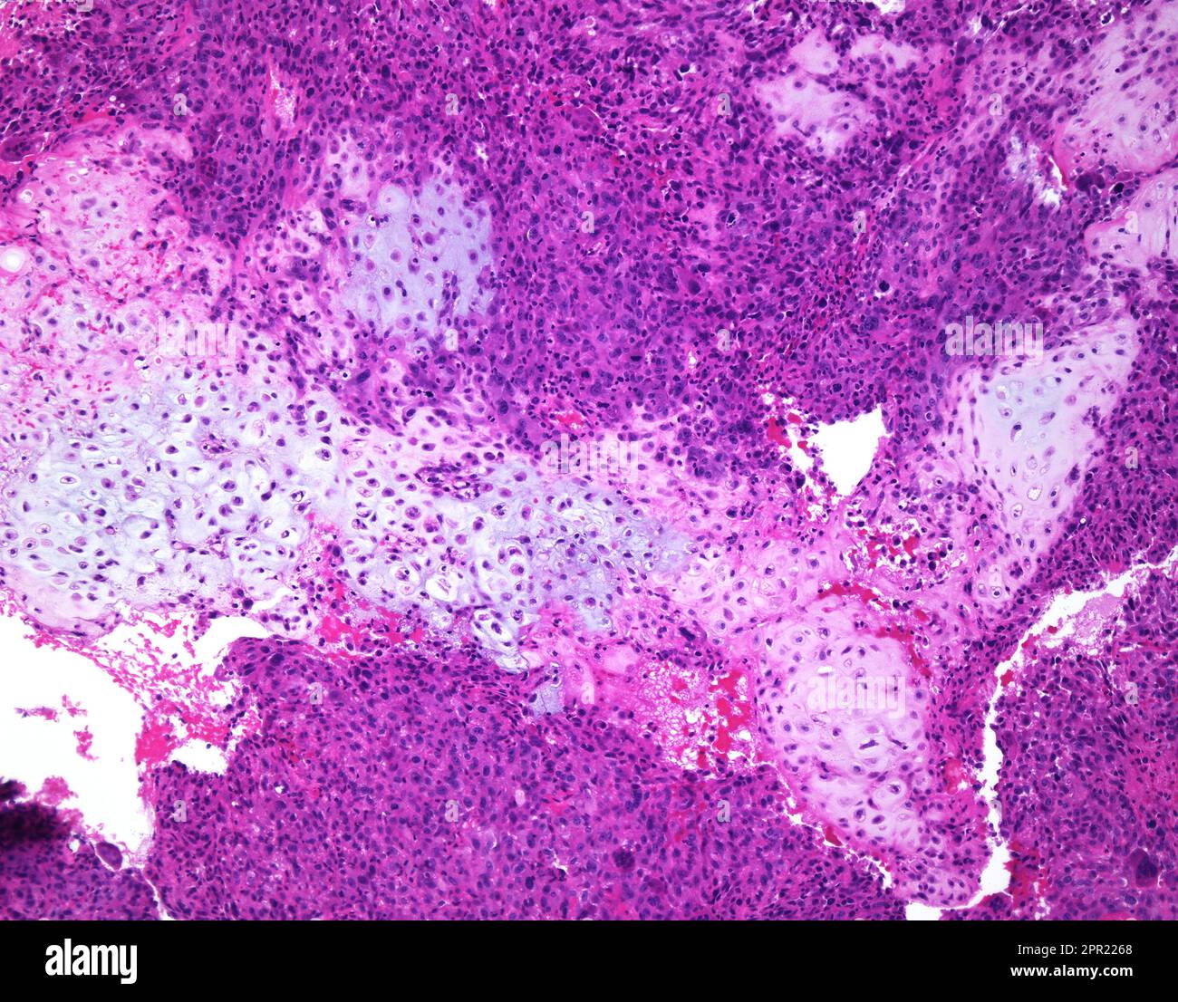 Dedifferentiated chondrosarcoma, light micrograph Stock Photo - Alamy