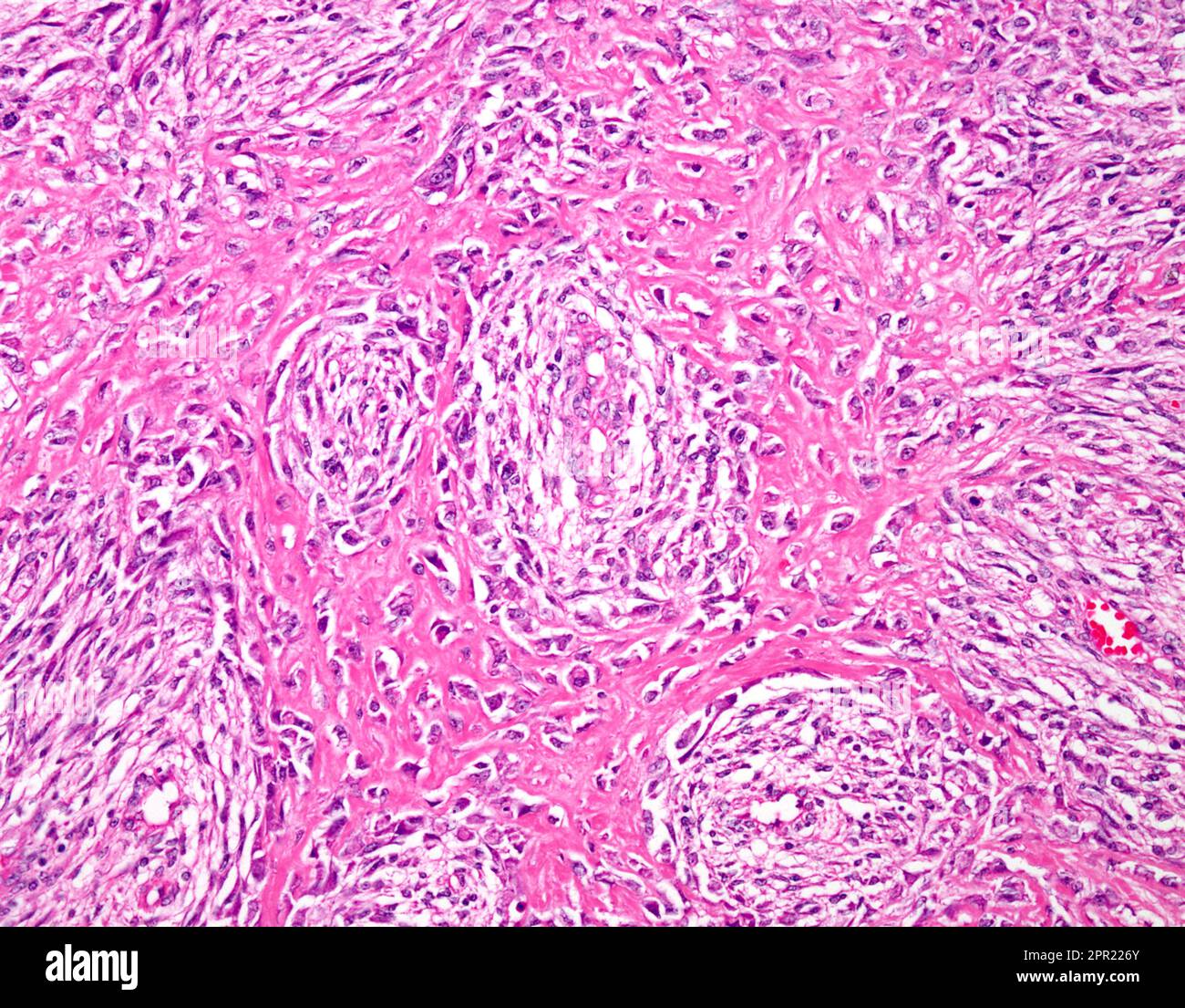 Fibroblastic osteosarcoma, light micrograph Stock Photo - Alamy