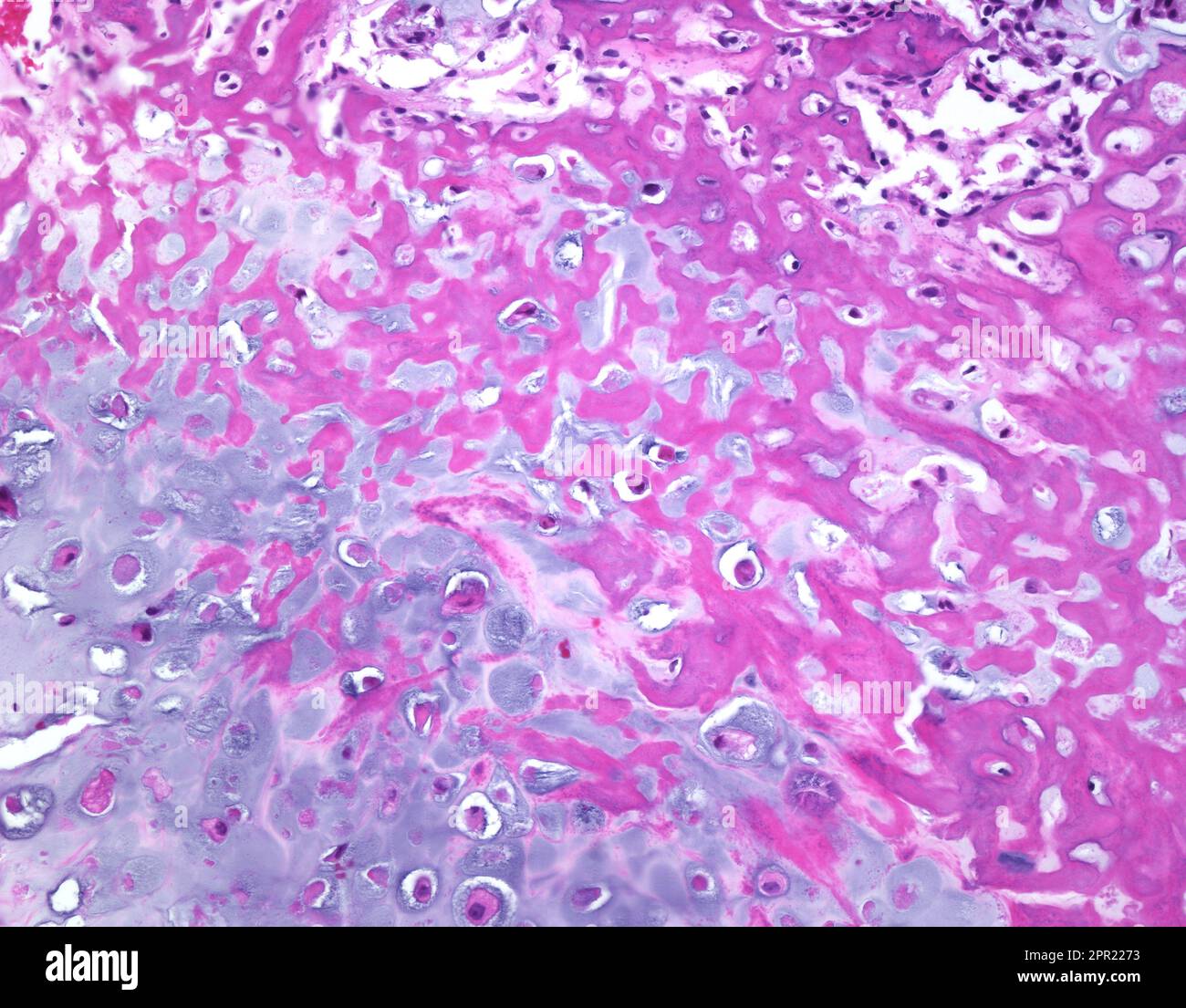 Osteosarcoma Histology