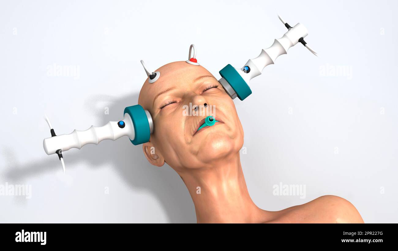 Electroconvulsive therapy, illustration Stock Photo - Alamy