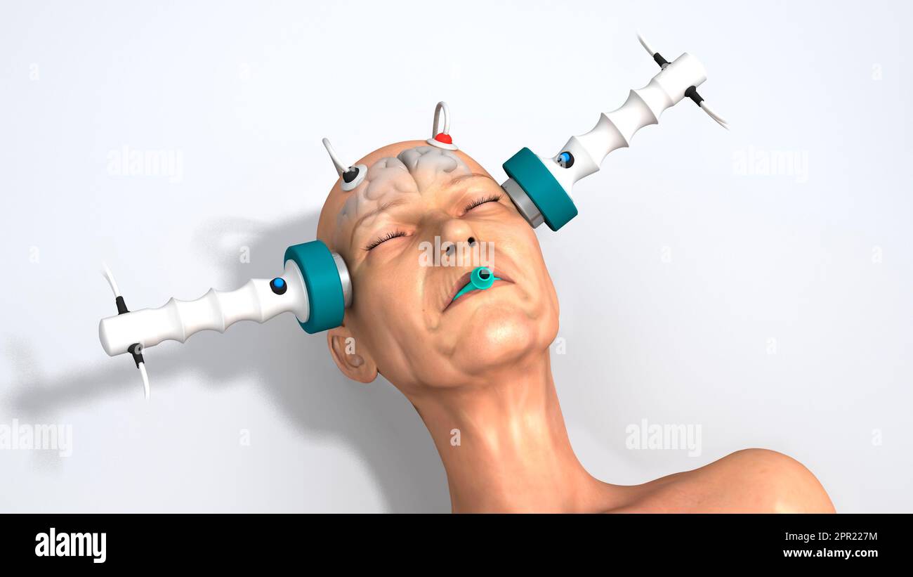 Electroconvulsive therapy, illustration Stock Photo - Alamy