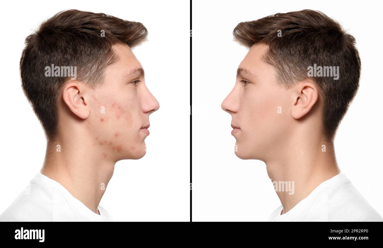 Puberty Before And After Boys