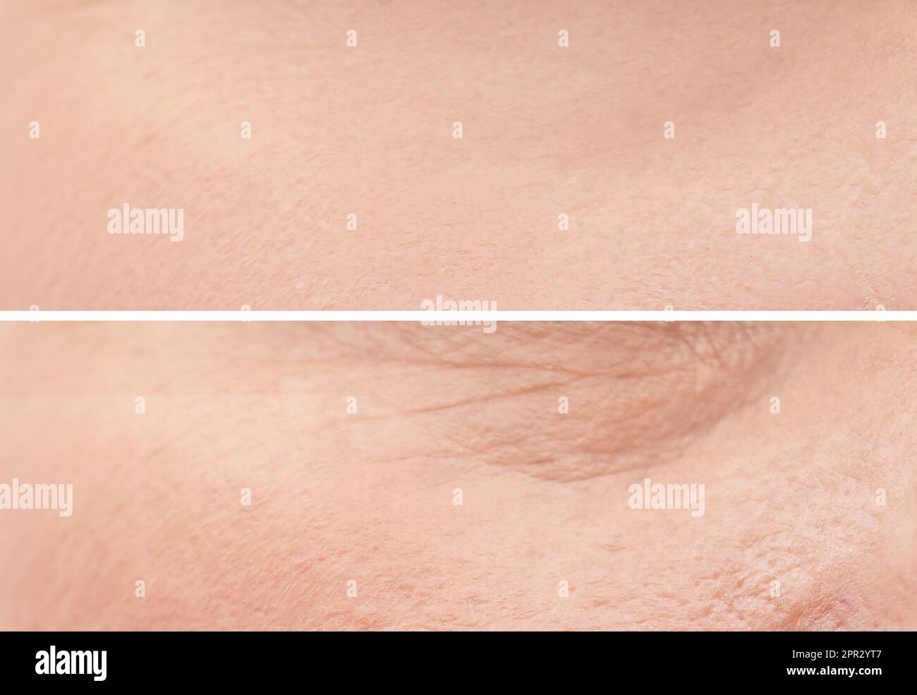 Collage with photos of dry and moisturized skin texture Stock Photo - Alamy