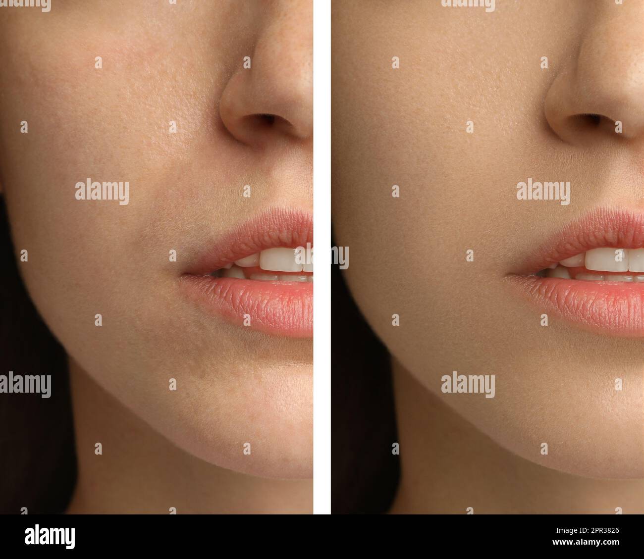 Collage with photos of woman having dry skin problem before and after moisturizing, closeup ...