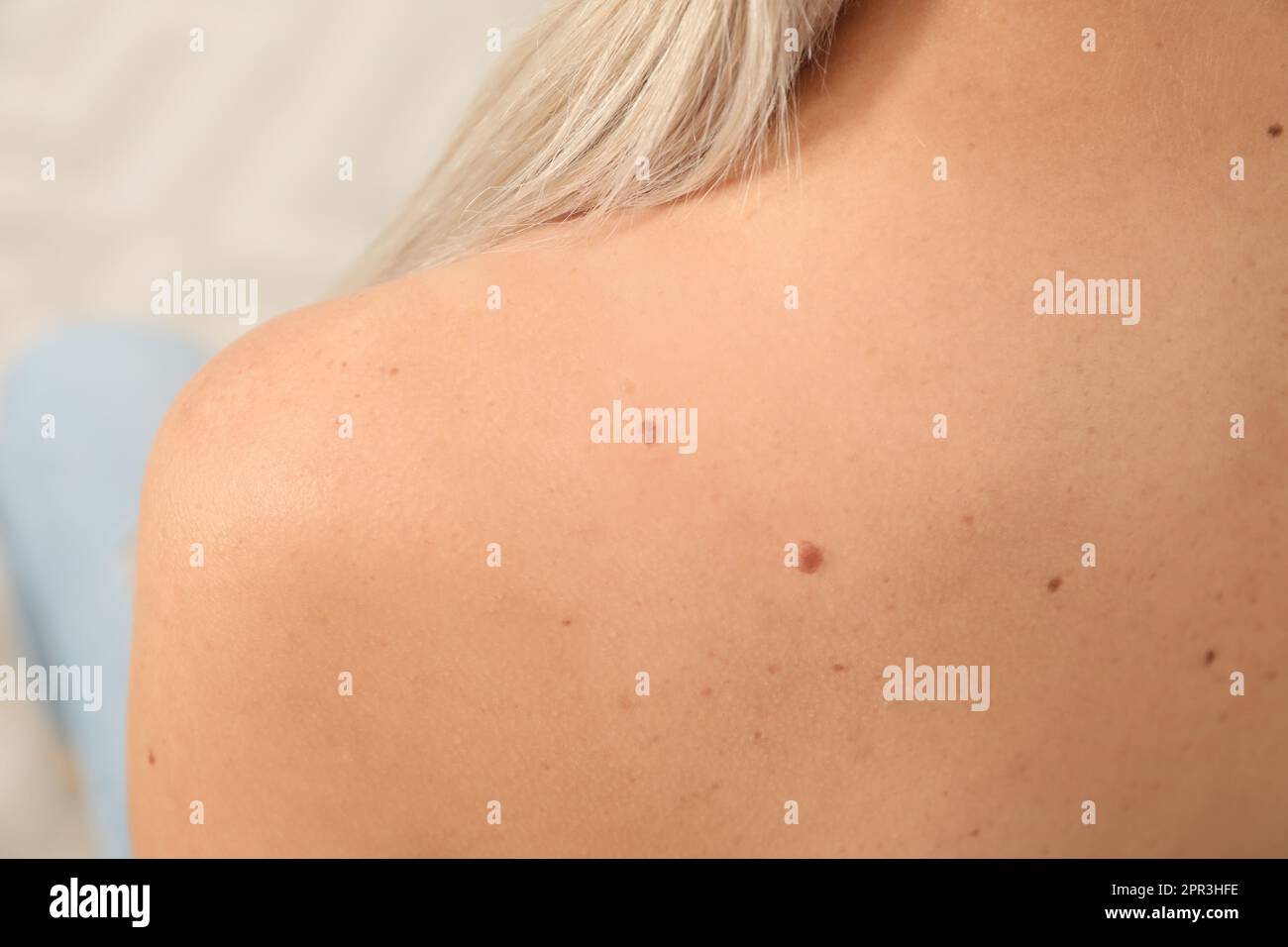 Closeup of woman`s body with birthmarks, back view Stock Photo - Alamy