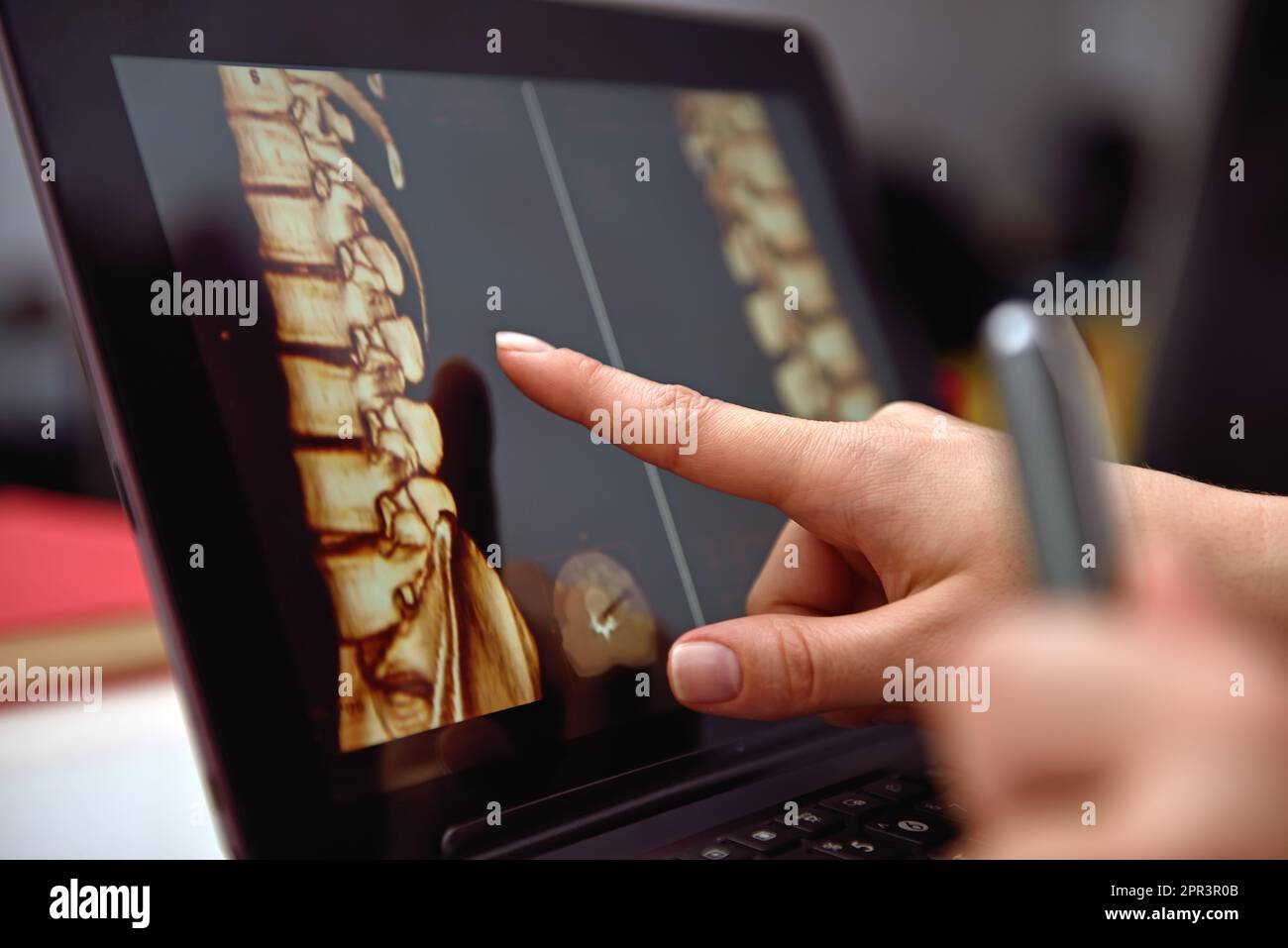 Hand pointing on screen with X-rays of the spine. close up Stock Photo ...