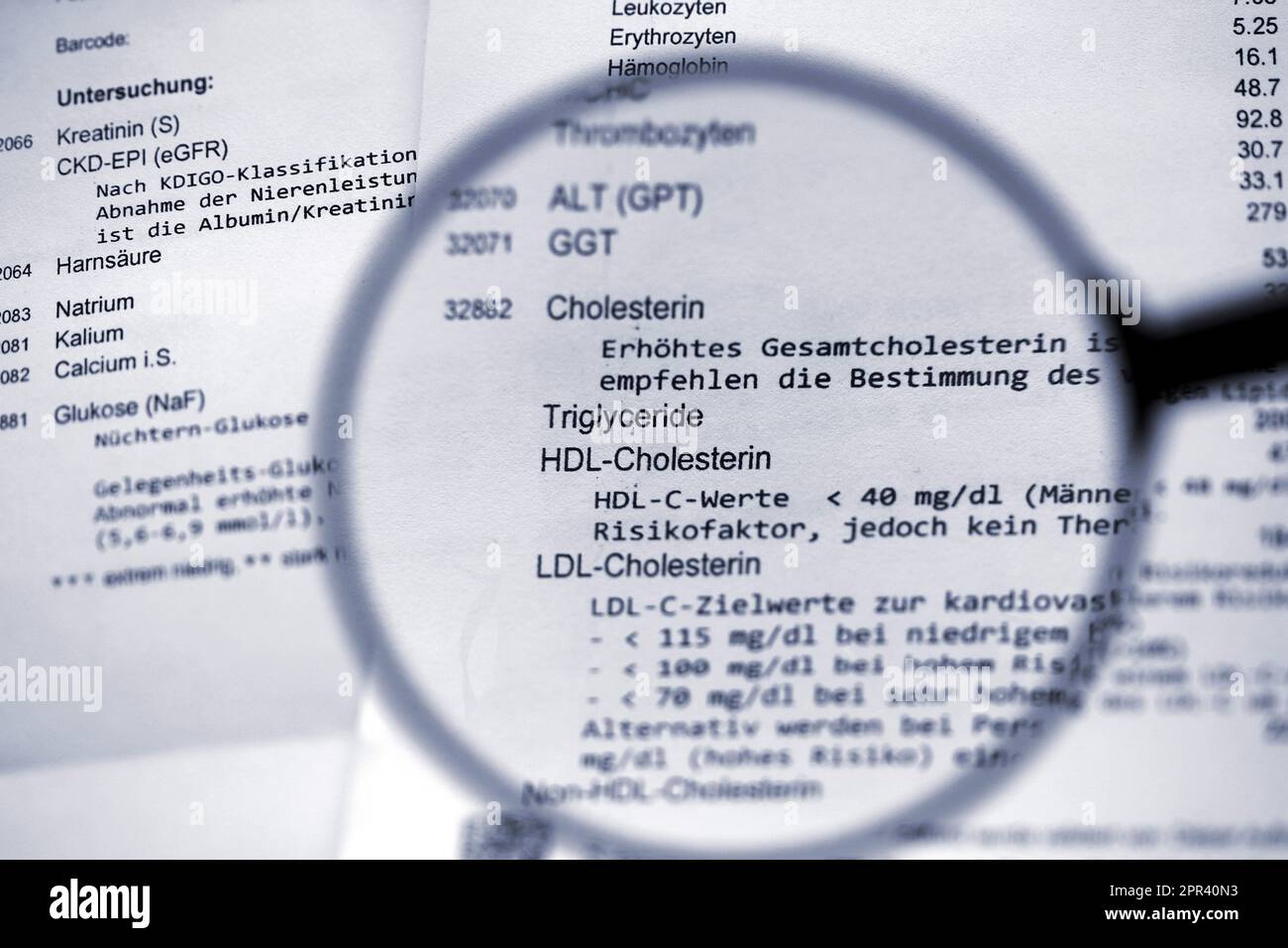 result of a blood test, haemogram, view with a loupe, cholesterol Stock ...