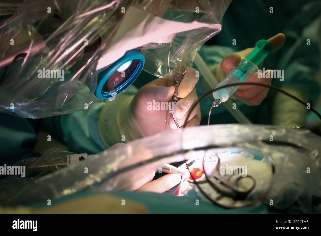 Medical doctors place an cochlear implant in a deaf person which will ...