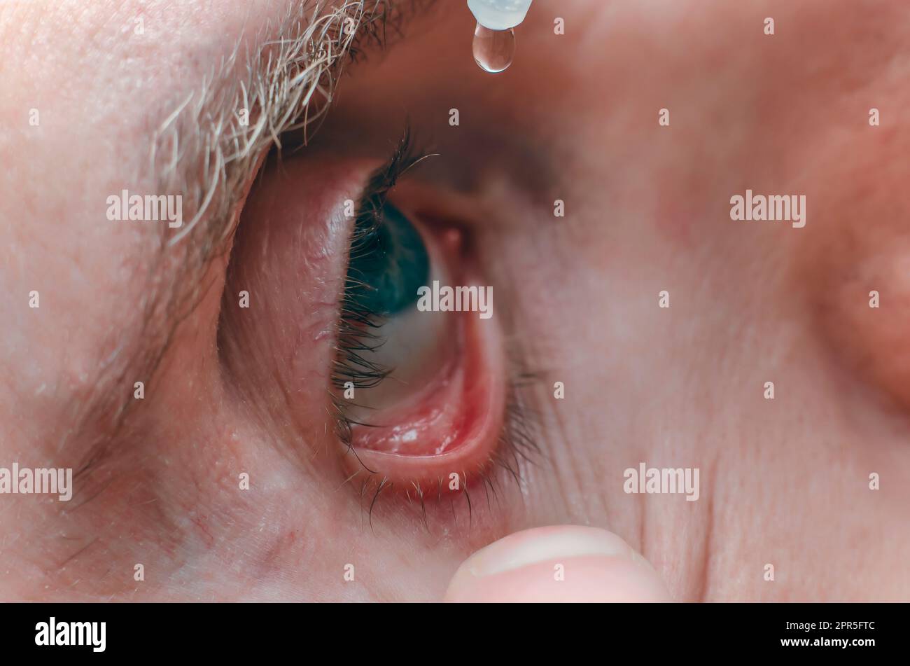 Instillation of drops into the eye. A man drips drops. Ophthalmology ...