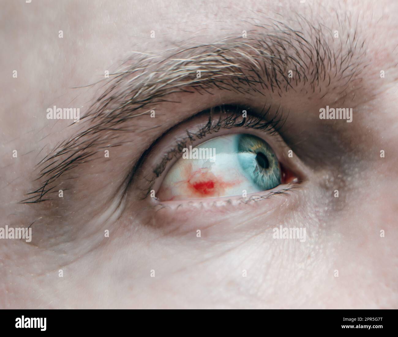 Ee of a man with a bursting vessel in the eyeball. Hemorrhage in the ...