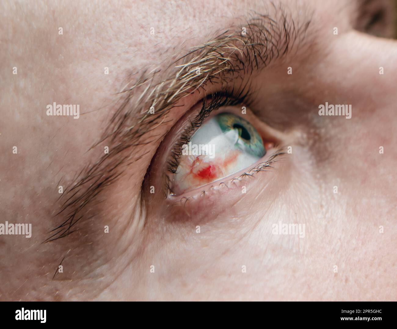 Ee of a man with a bursting vessel in the eyeball. Hemorrhage in the ...