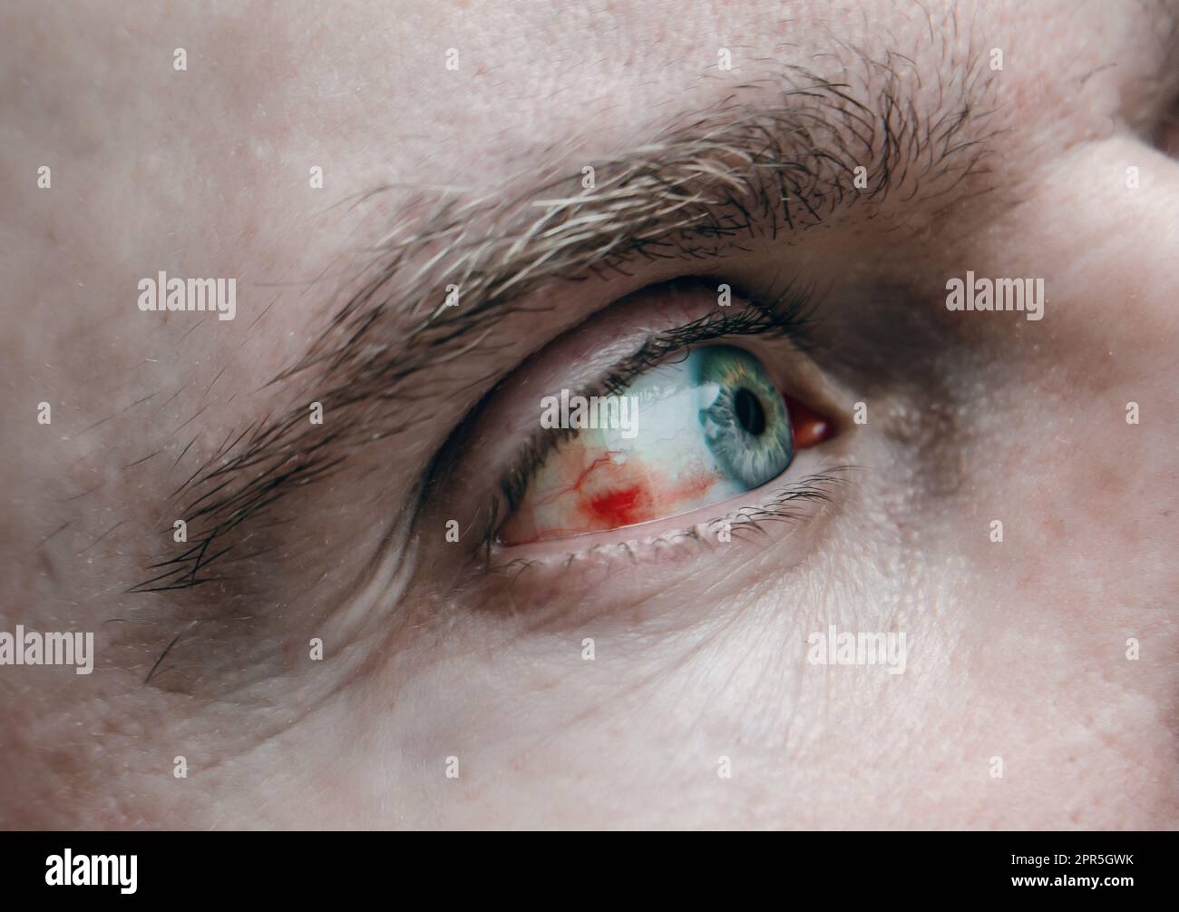Hemorrhage of the eye hi-res stock photography and images - Alamy