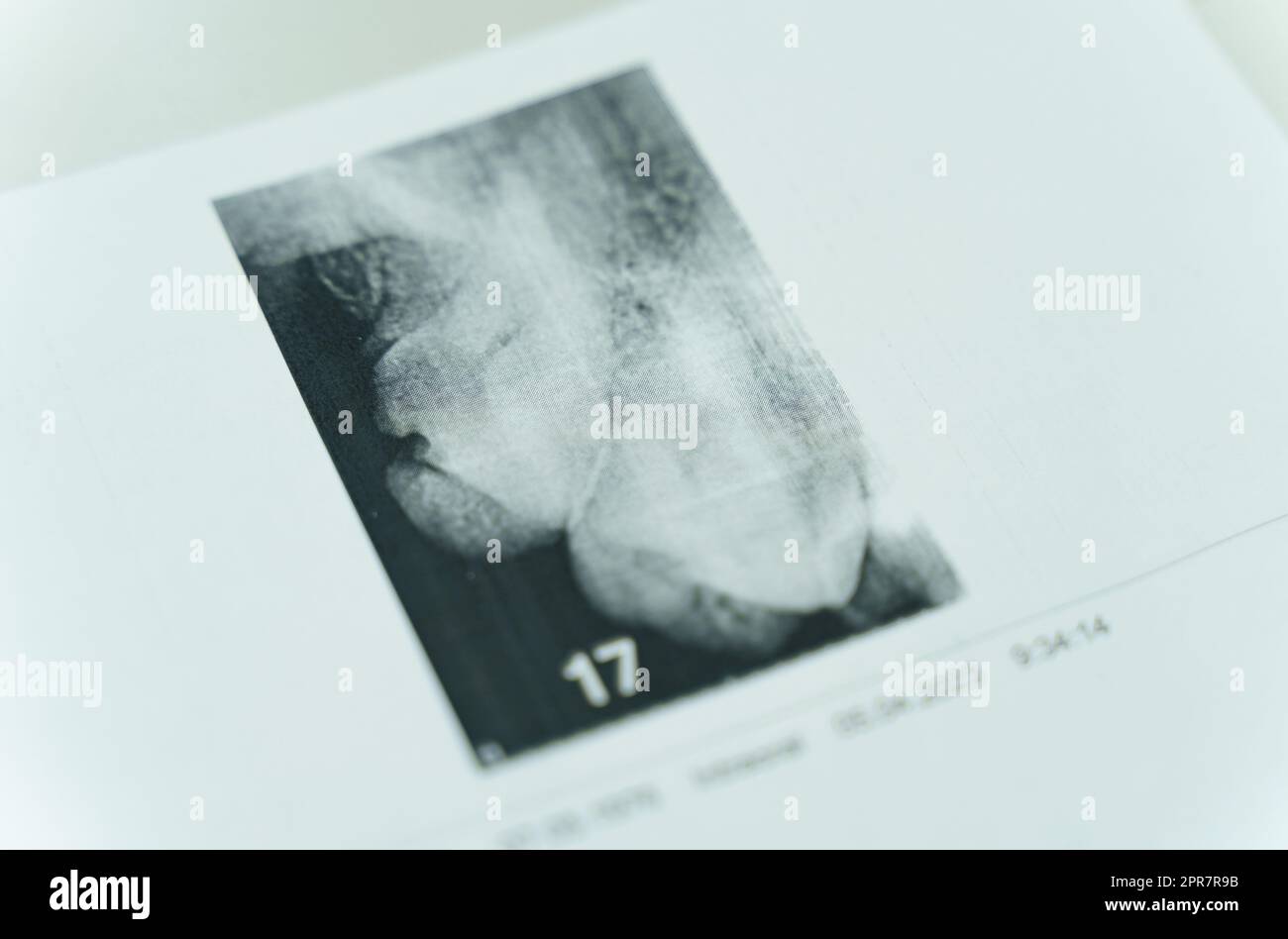 On the table is a close-up printout of two teeth Stock Photo - Alamy