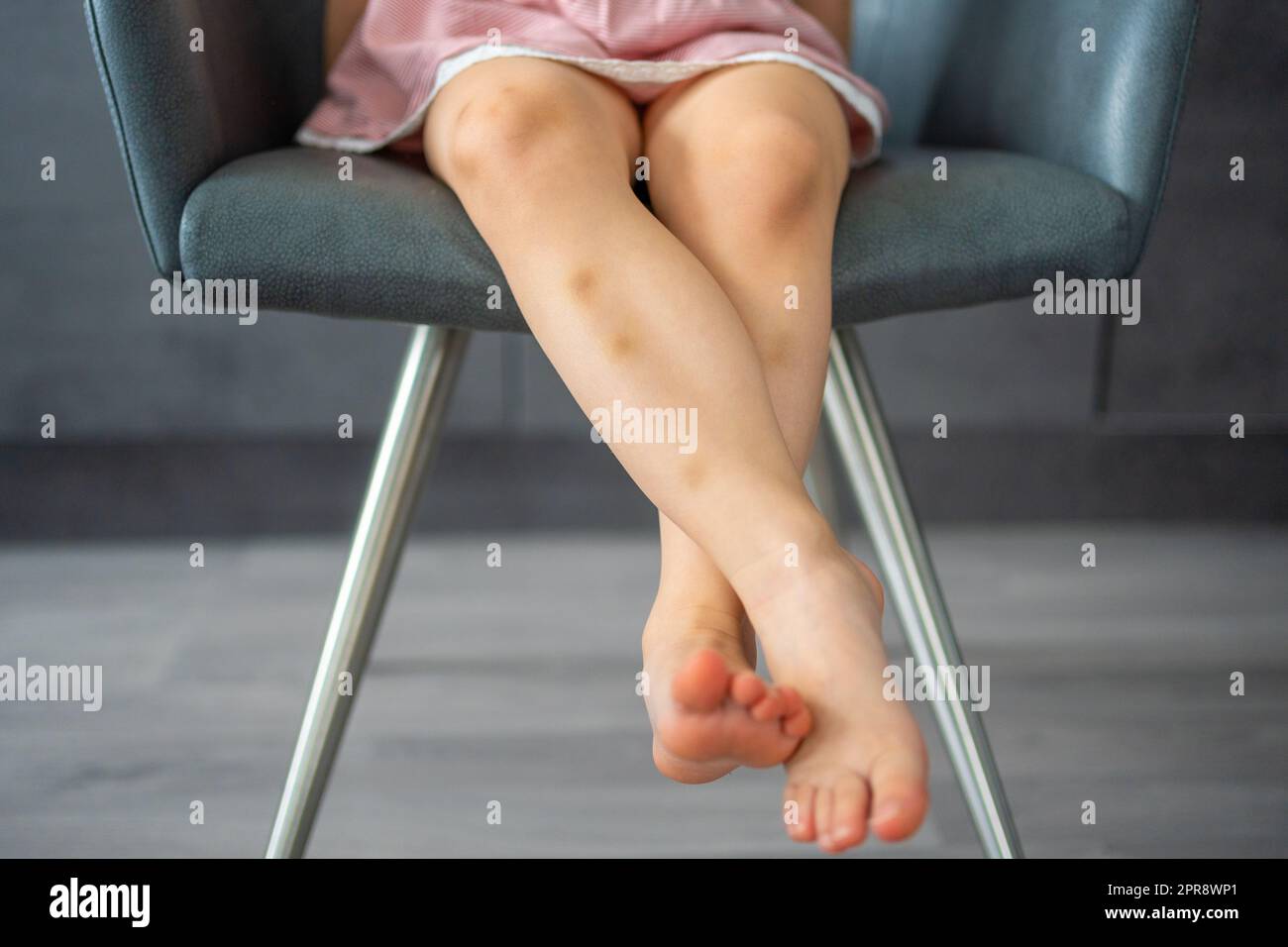 Close up of stains bruise wound on legs of little girl. Extravasation ...