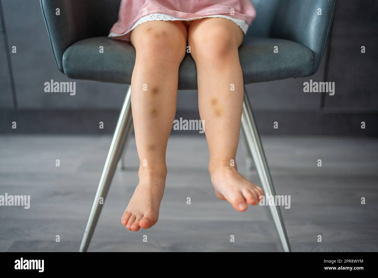 Close up of stains bruise wound on legs of little girl. Extravasation ...
