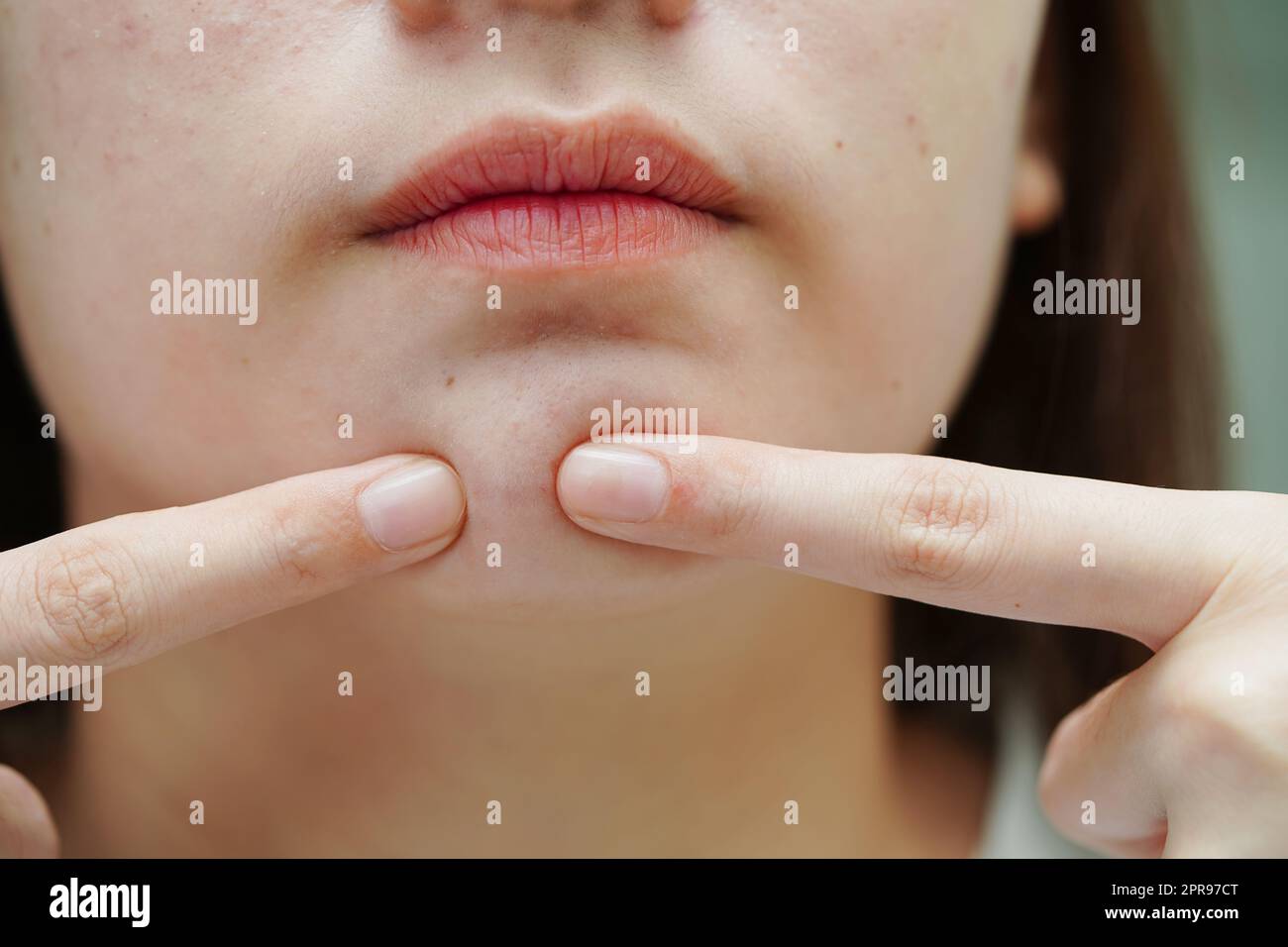 Acne pimple and scar on skin face, disorders of sebaceous glands ...