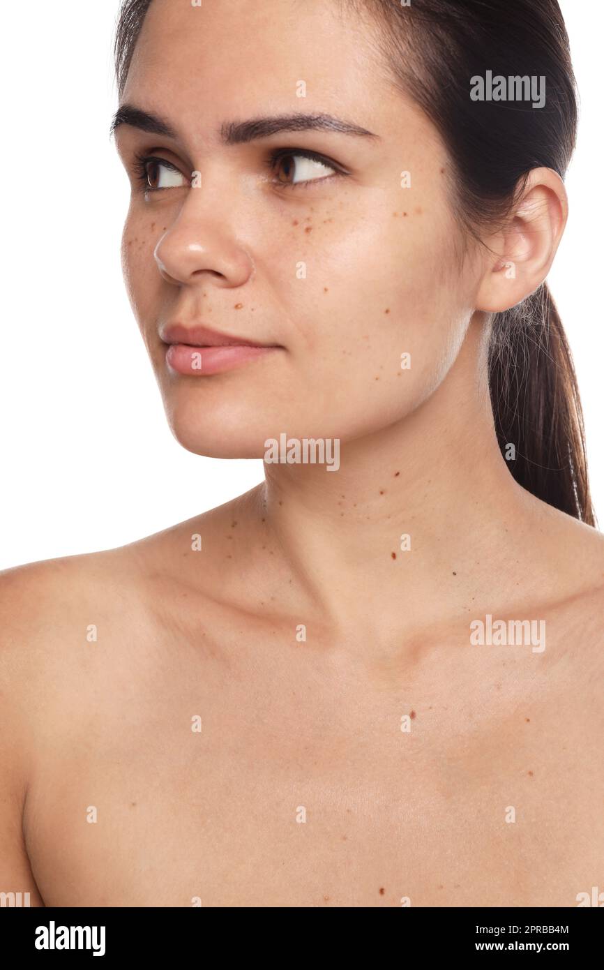 Beautiful woman with birthmarks on white background Stock Photo - Alamy
