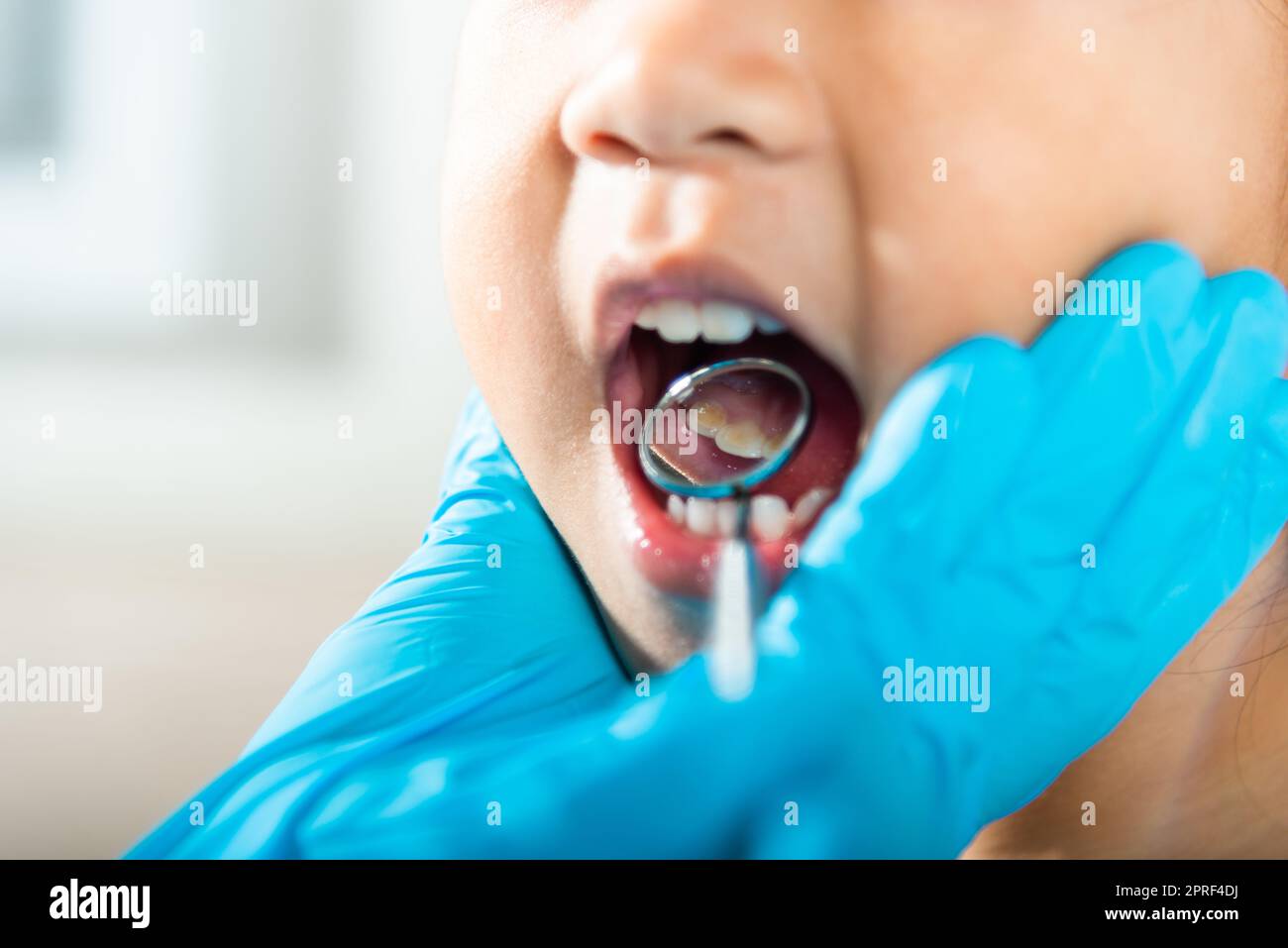 Doctor examines oral cavity of little child uses mouth mirror to ...